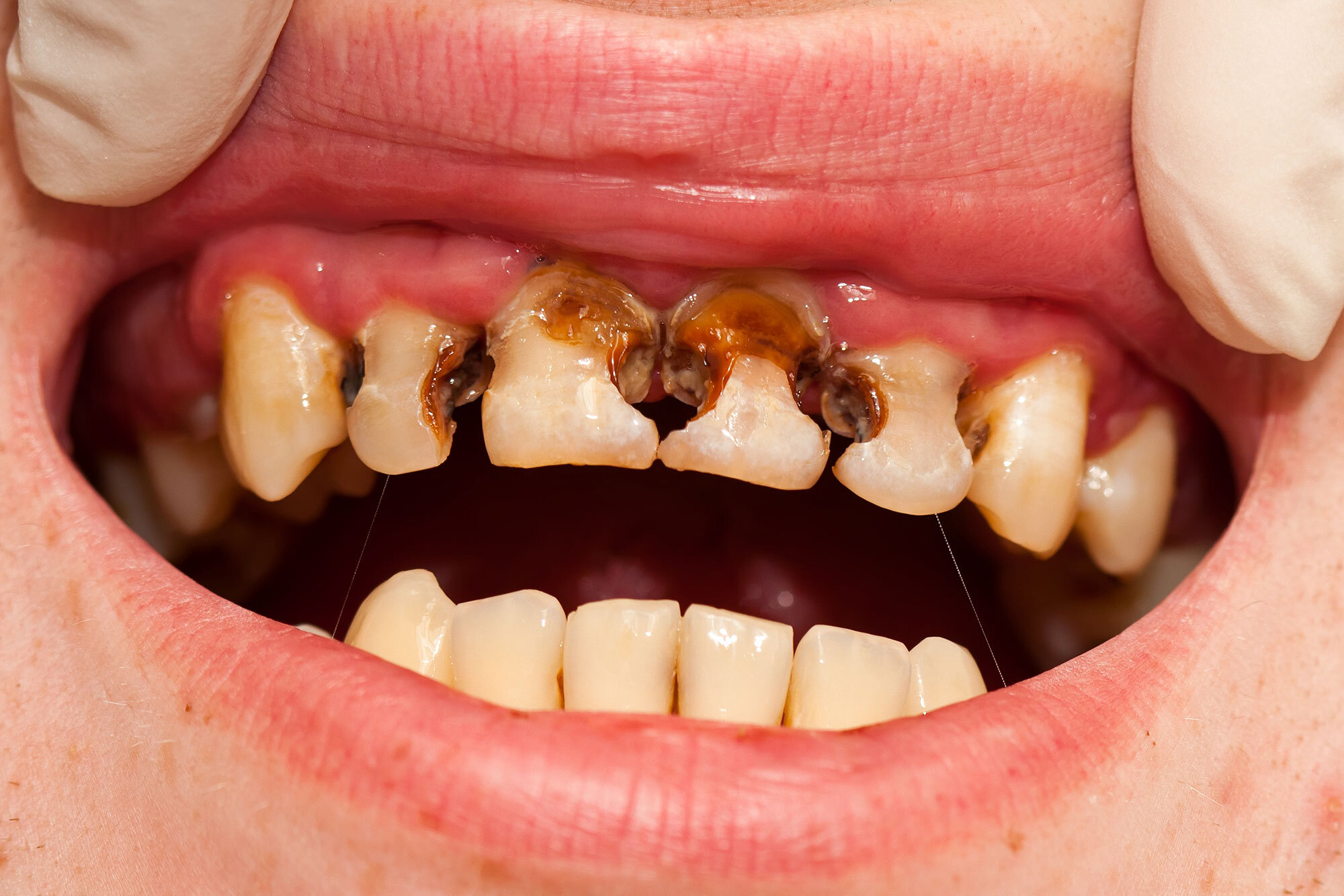 Cavities and Tooth Decay: Symptoms, Causes & Treatment - Smile Vizag Dental