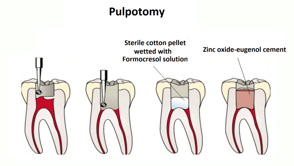 Pulpectomy Indications and Contraindications - Smile Vizag Dental