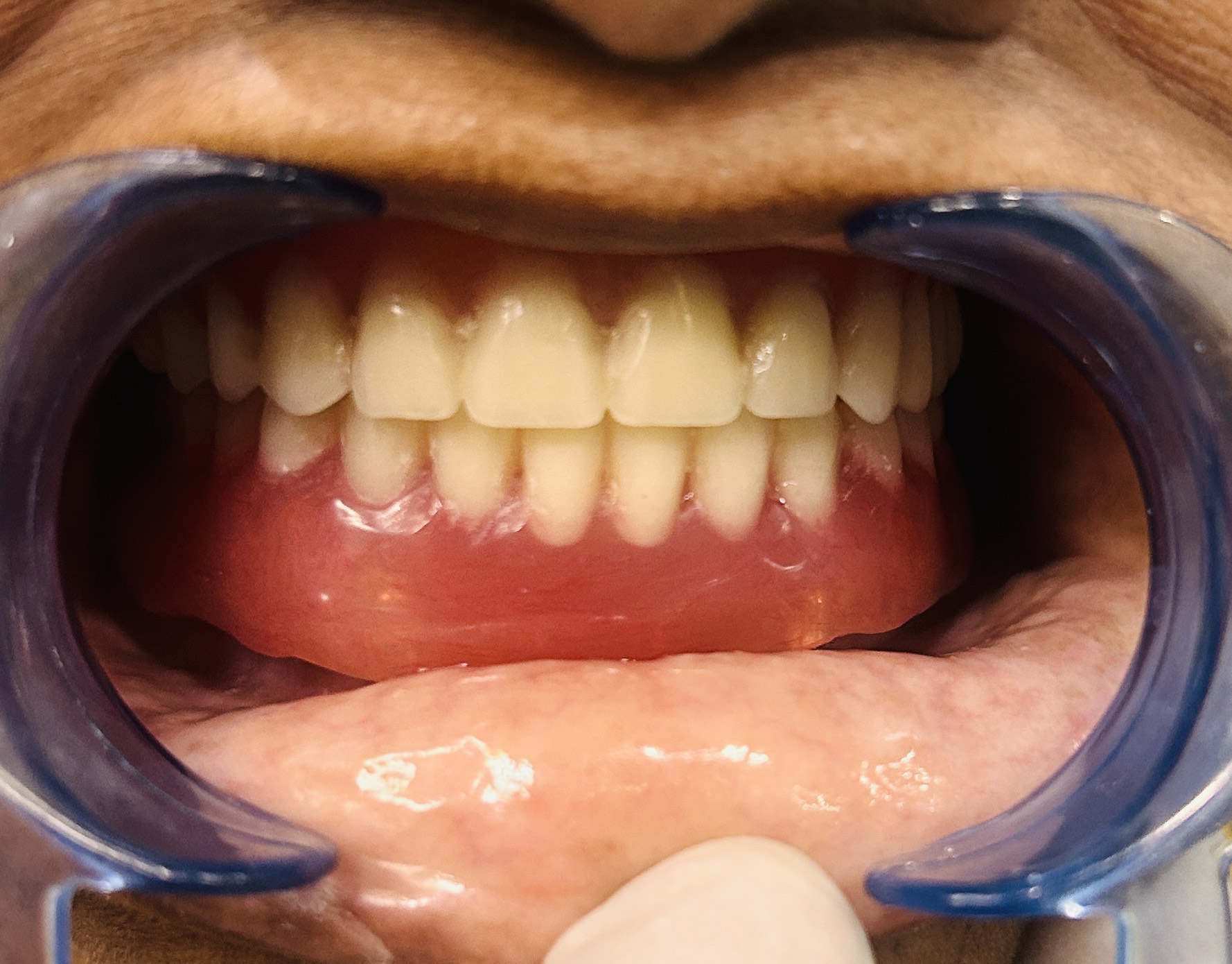 Tooth Supported Over Denture - Smile Vizag Dental